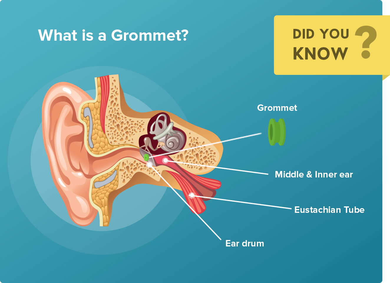 How Much Does Ear Grommet Surgery Cost In Australia 